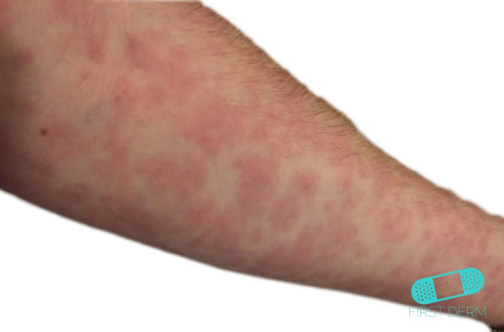 Erythema Multiforme - Online Dermatology