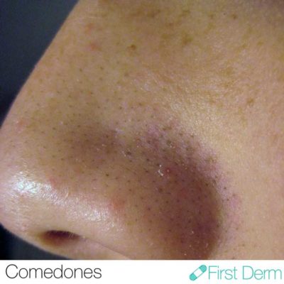 Sebum Plugs: Everything You Need To Know