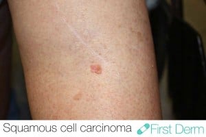 - Squamous cell carcinoma