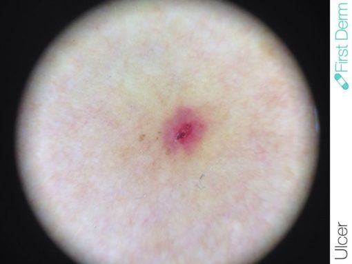 Ulcer | First Derm
