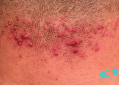 Follikulit (hårsäcksinflammation) - Hudläkare på nätet