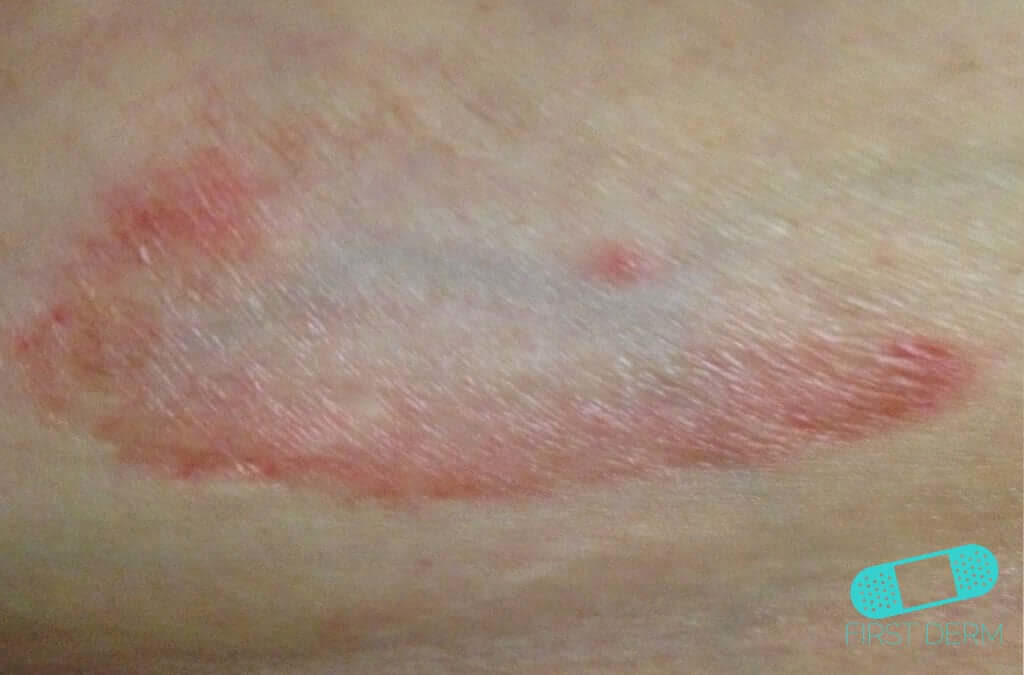 Granuloma Annulare And Stress