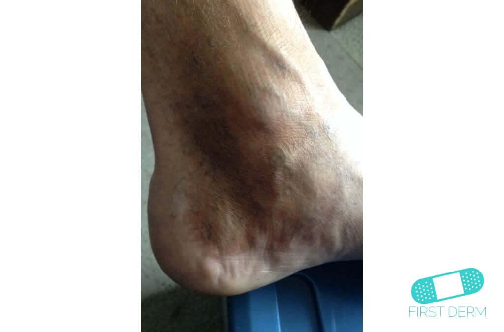 Guía de la piel - Hiperpigmentación