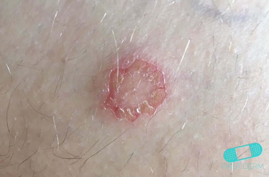 Guía de la Piel - Impétigo (infección de escuela)