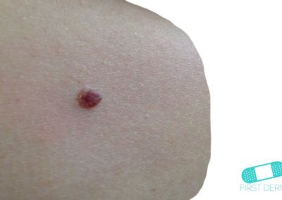 Intradermal nevus - Online Dermatology