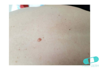 Intradermal nevus - Online Dermatology