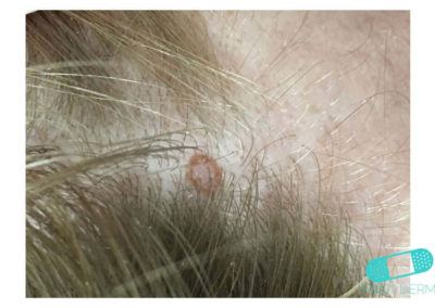 Intradermal nevus - Online Dermatology