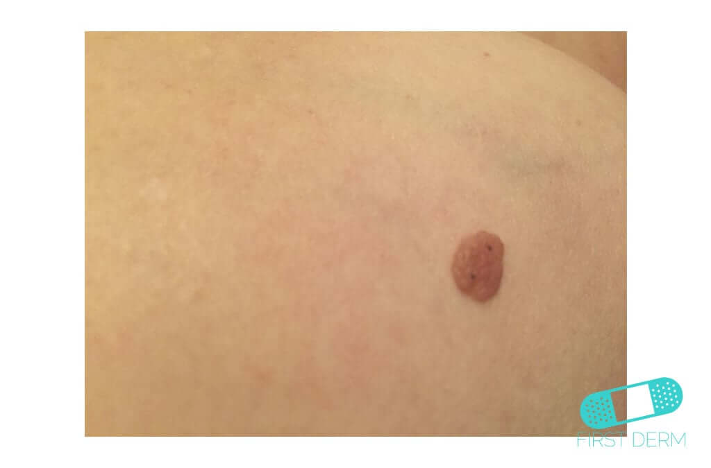 Intradermalt nevus - Hudläkare på nätet - First Derm