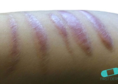 Keloid (Hypertrophic Scar)