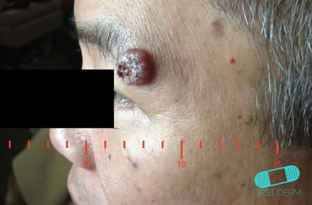 Keratoacanthoma - Online Dermatology