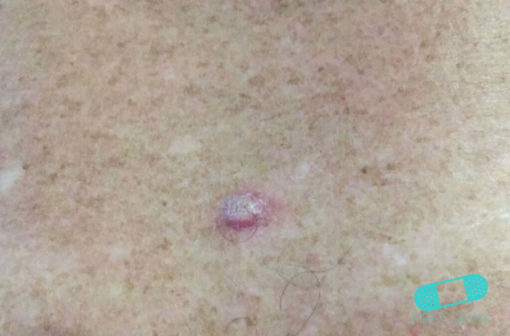 Keratoacanthoma - Online Dermatology