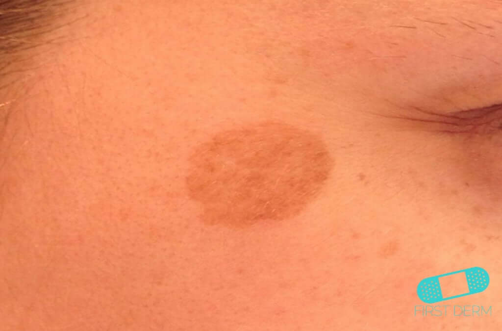 Lentigo Solar (Manchas Hepáticas) - Guía de la piel