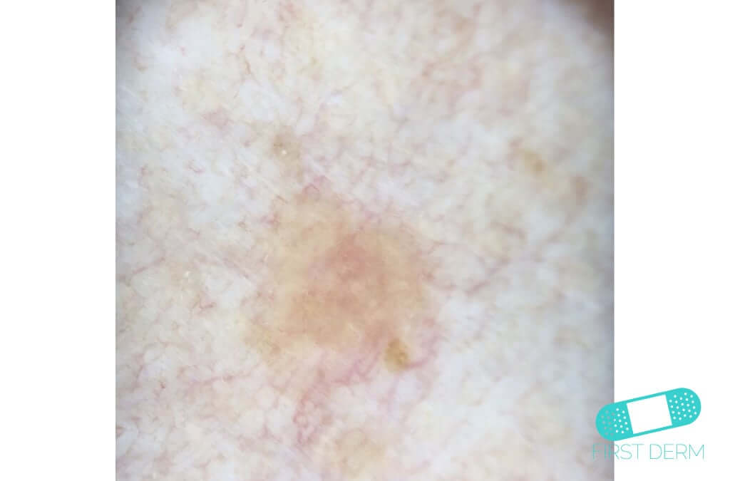 Guía de la piel - Lentigo Solar (Manchas Hepáticas)