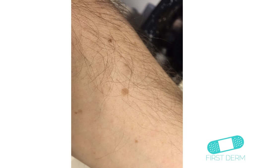 Lentigo solaris (Liver Spots) - Online Dermatology