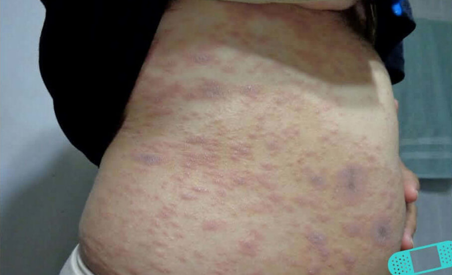 Lichen Planus - Online Dermatology