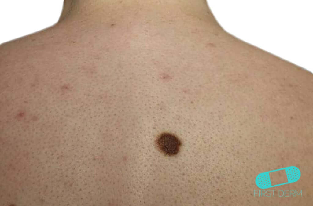 Pequeño Lunar Negro En La Piel