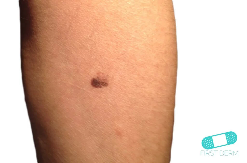 Melanoma Maligno - Guía de la piel