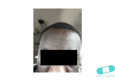 Online Dermatology - Melasma (Chloasma)