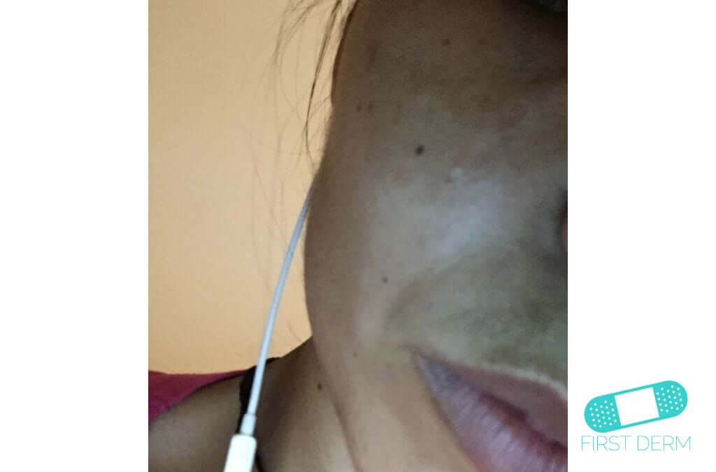 Melasma (Chloasma) - Online Dermatology