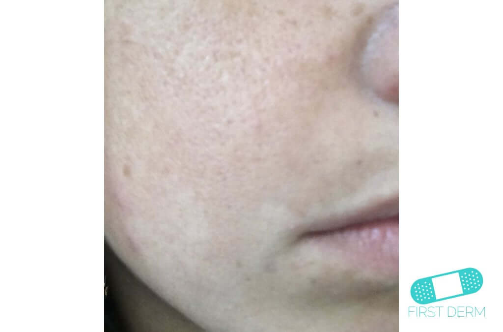 Melasma (Chloasma) - Online Dermatology