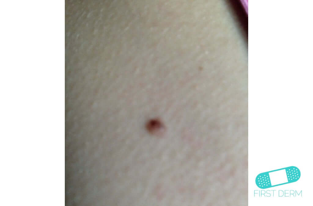 Mole (Congenital nevus)- Online Dermatology