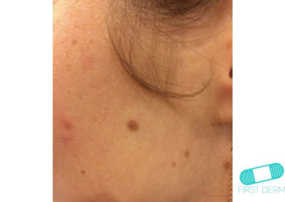 Mole (Congenital nevus)- Online Dermatology
