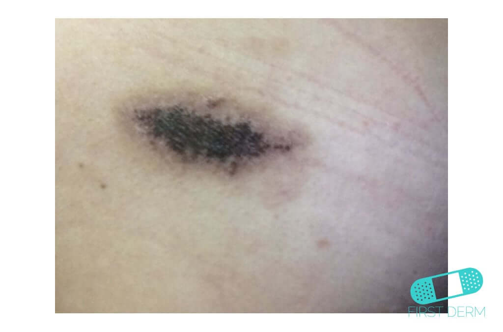 Mole (Congenital nevus)- Online Dermatology
