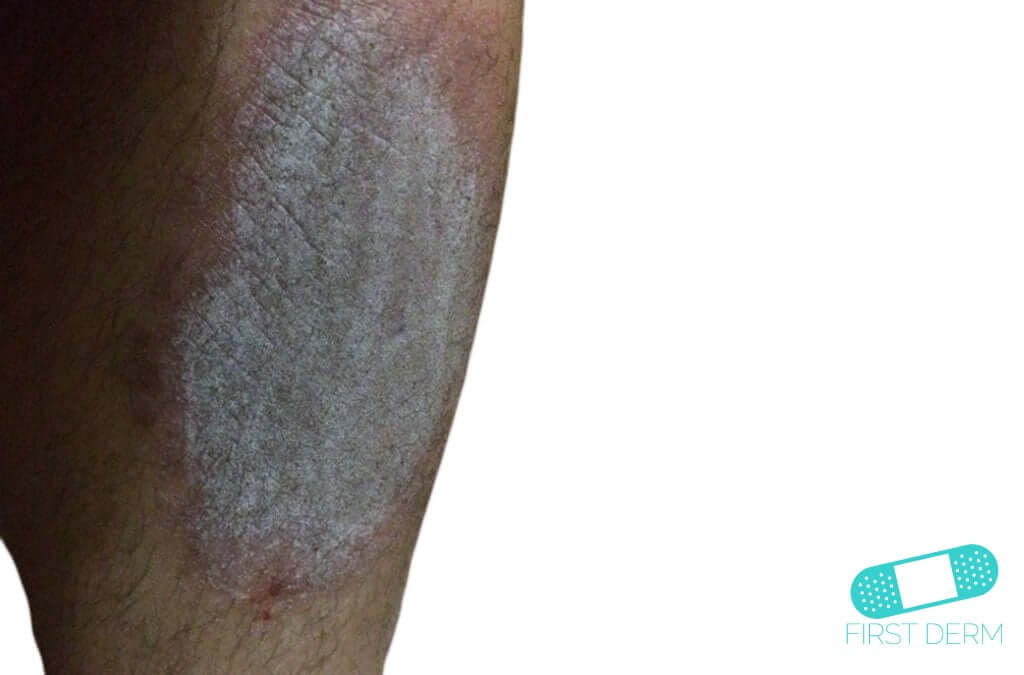 Neurodermatitis - Online Dermatology