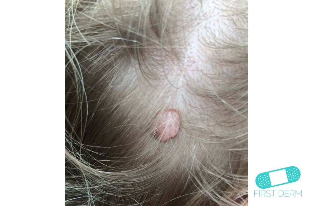 Nevus intradérmicos - Guía de la piel
