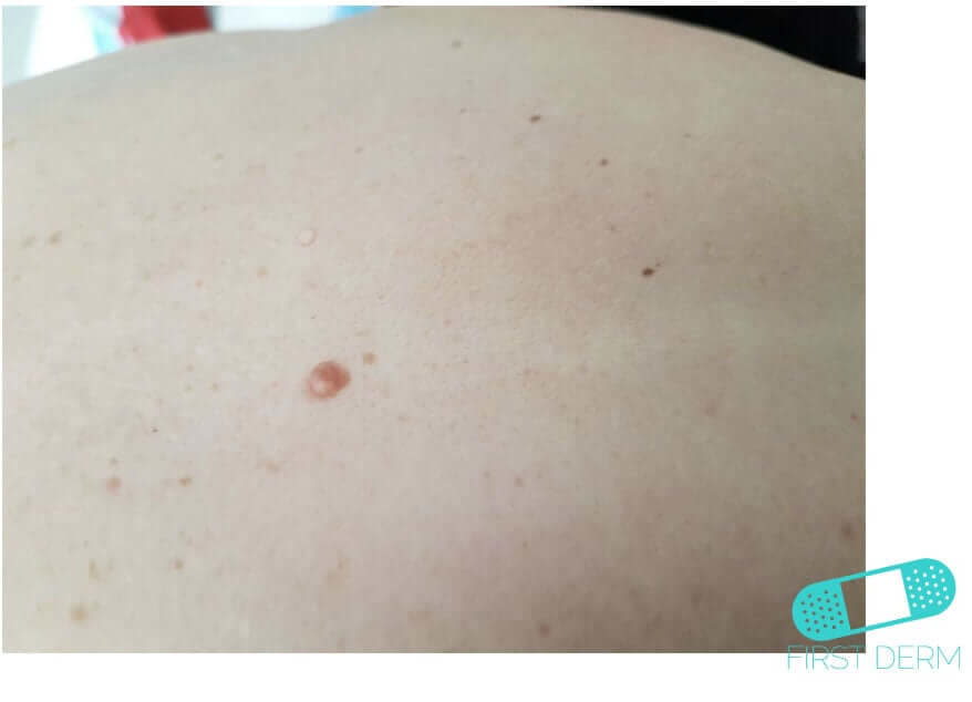 Guía de la Piel - Nevus intradérmicos