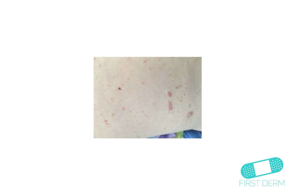 Nummular Eczema (Discoid Dermatitis) - Online Dermatology