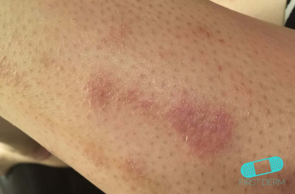 Nitr geno Es Asistir Pomada Para Eczema Numular Adverbio Doblado Ambiente nitr-geno-es-asistir-pomada-para-eczema-numular-adverbio-doblado-ambiente