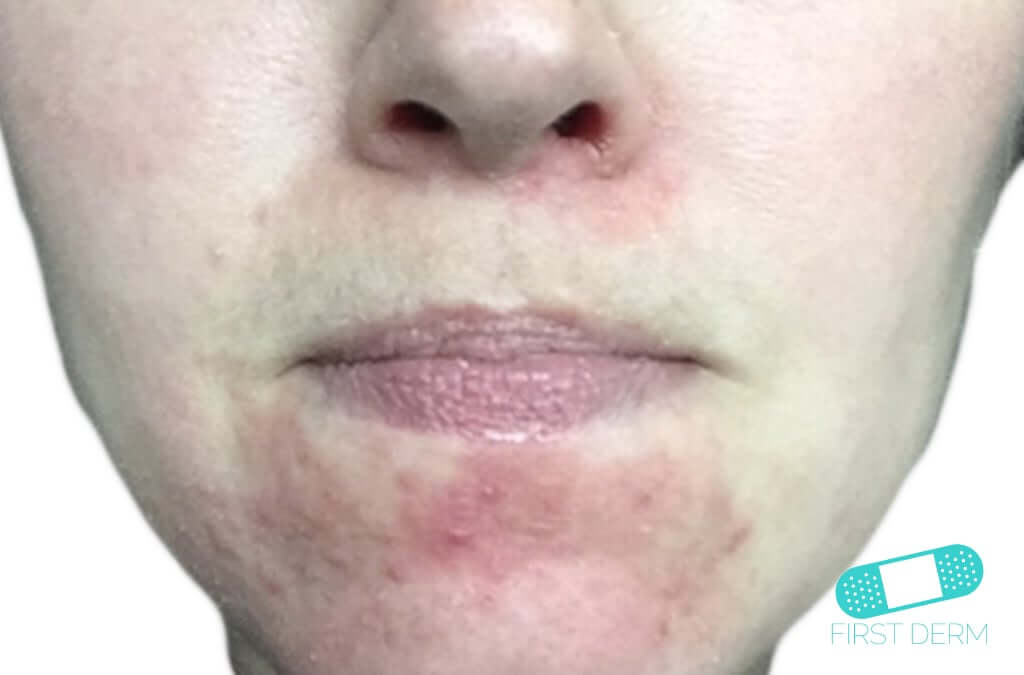 Perioral Dermatitis - Online Dermatology