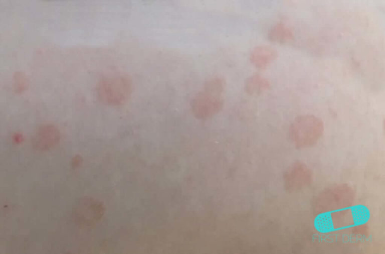 Itchy Rash Pictures: 6 most common cases and their treatment