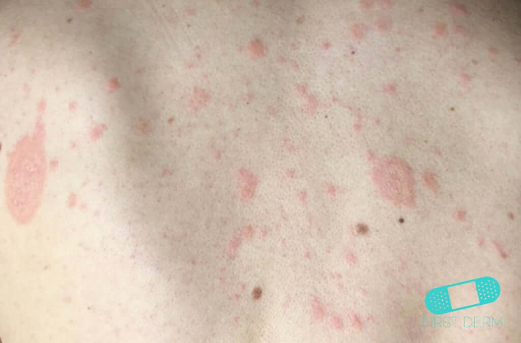 Pityriasis rosea (fjällros) - Hudläkare på nätet