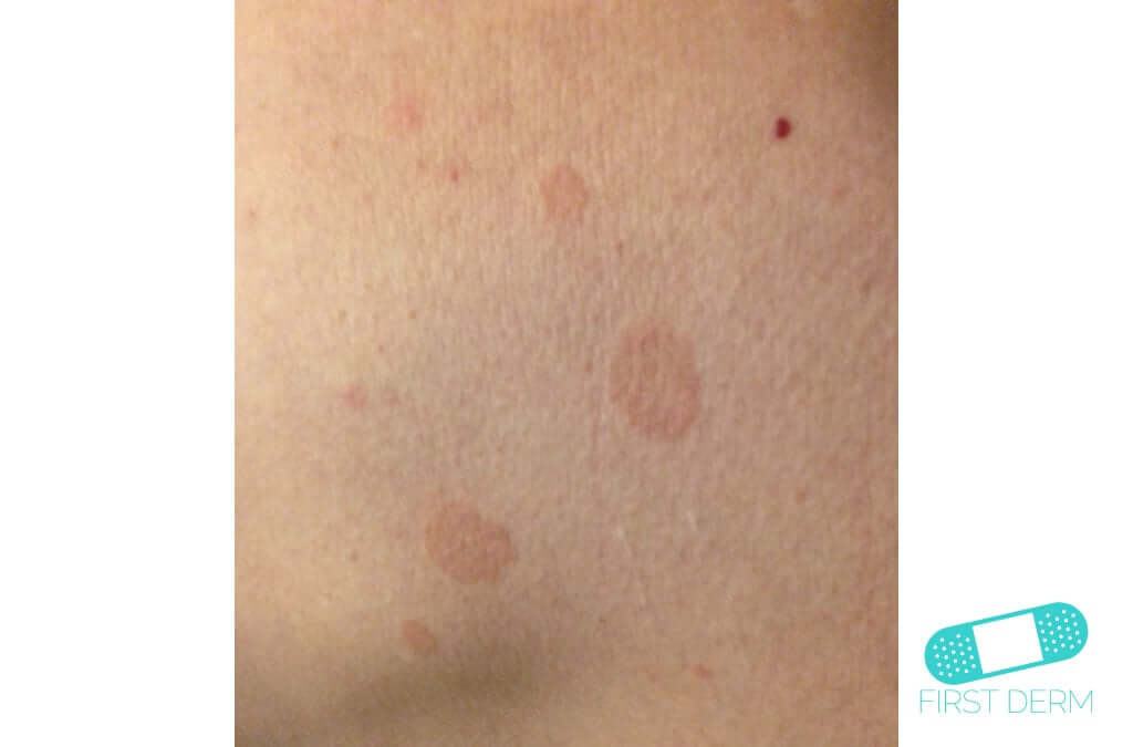 Hudläkare på nätet – Pityriasis versicolor (tinea verisicolor)