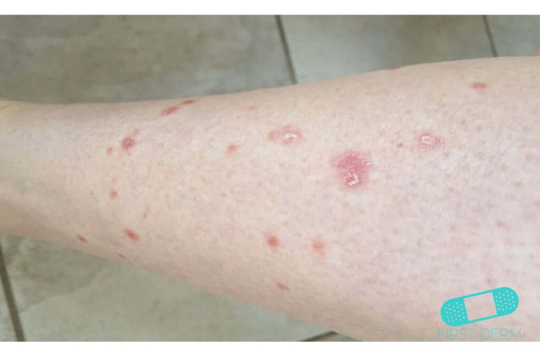 Itchy Red Bumps on Skin – Potential Causes and Treatment