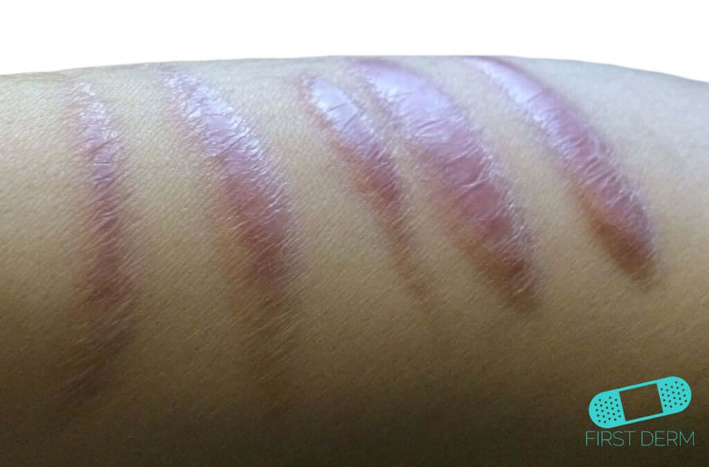 Cicatriz Hipertrofica Vs Piercing Queloide