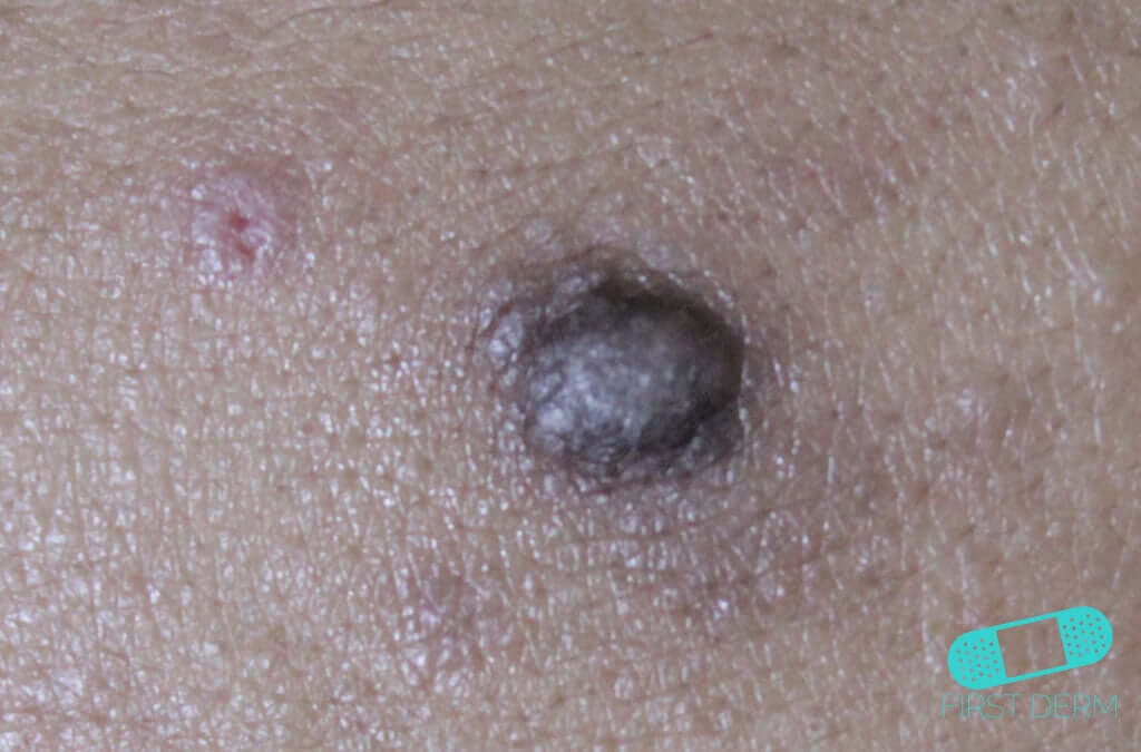 Queloide En Ingles Sale Cheapest | brunofuga.adv.br