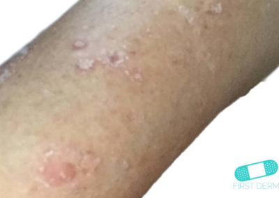 Queratosis Actínica - Guía de la Piel - Dermatólogos en línea