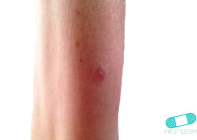 Queratosis Actínica - Guía de la Piel - Dermatólogos en línea