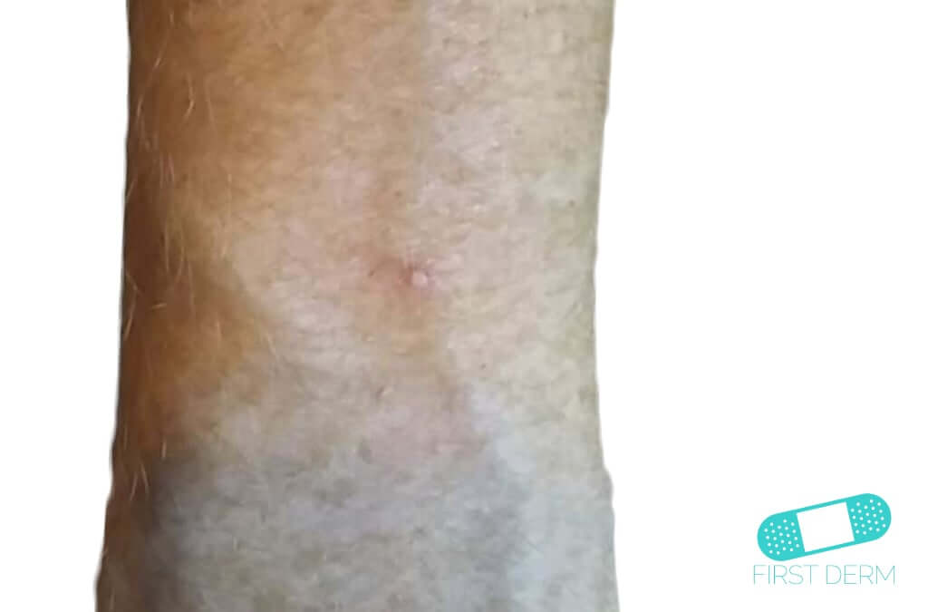 Queratosis Actínica - Guía de la Piel - Dermatólogos en línea