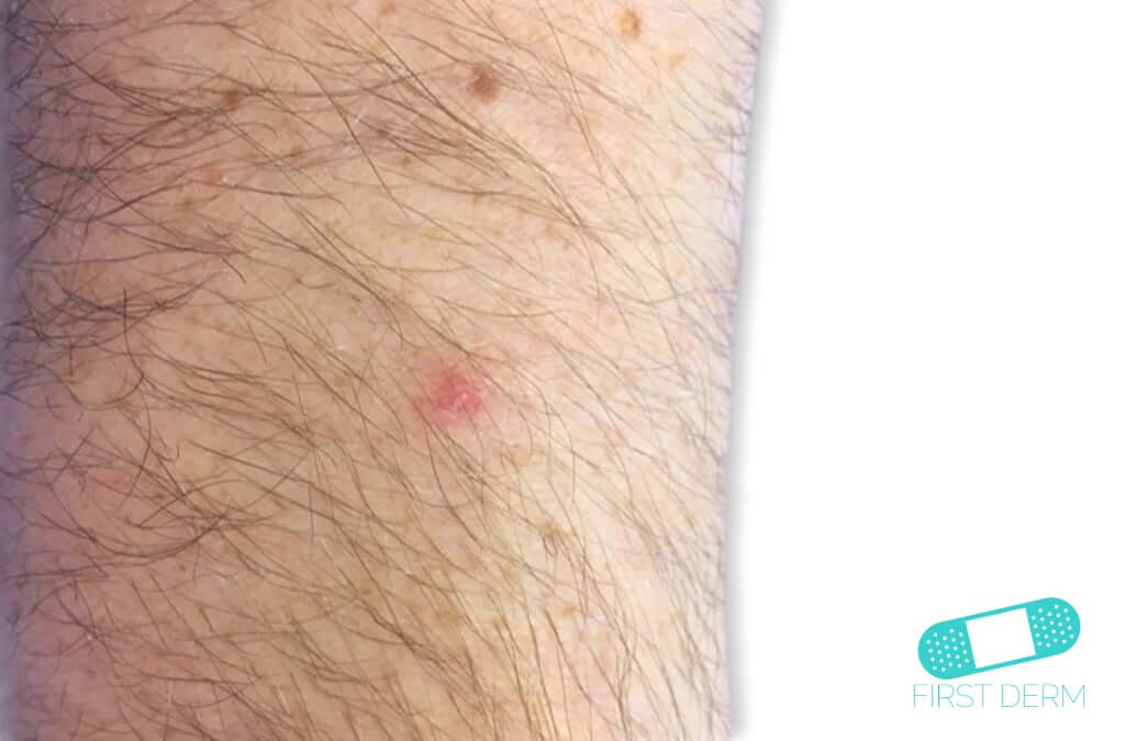 Queratosis Actínica - Guía de la Piel - Dermatólogos en línea