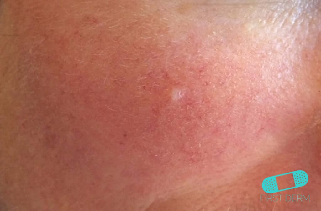 Queratosis Actínica - Guía de la Piel - Dermatólogos en línea