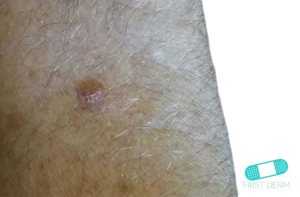 Queratosis Actínica - Guía de la Piel - Dermatólogos en línea