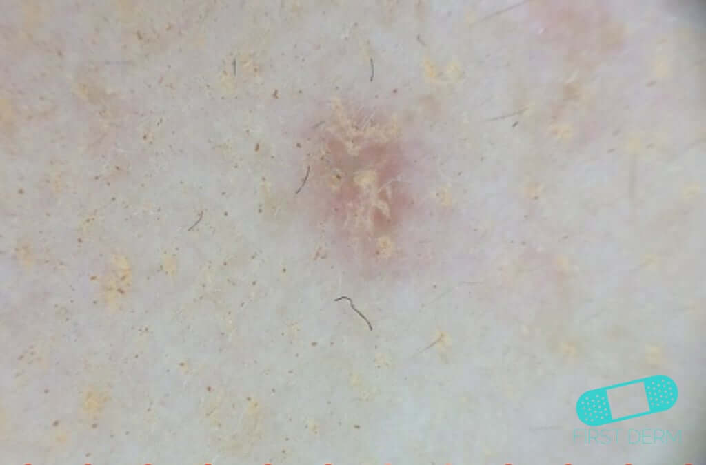 Queratosis Actínica - Guía de la Piel - Dermatólogos en línea