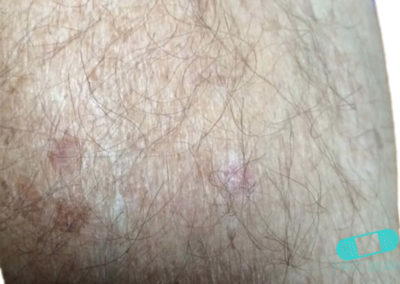 Queratosis Actínica - Guía de la Piel - Dermatólogos en línea