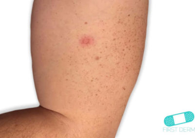 Queratosis Actínica - Guía de la Piel - Dermatólogos en línea