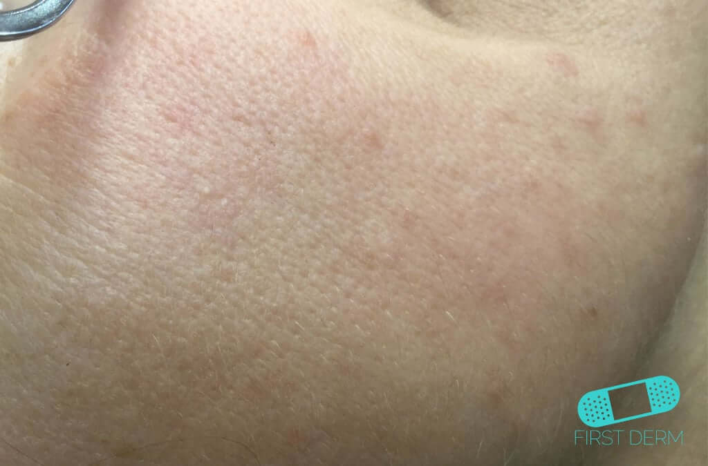 Online Dermatology Rosacea online-dermatology-rosacea