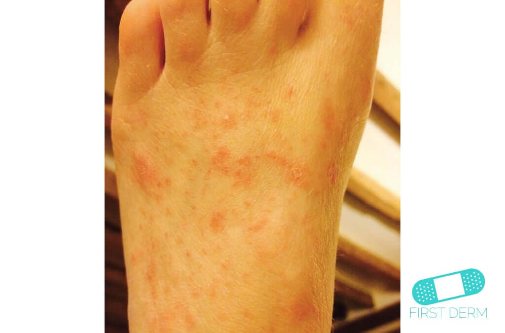 Sarna - Online Dermatology